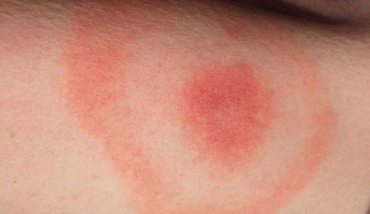 È necessario fare molta attenzione ai morsi di zecche - Felicità Pubblica